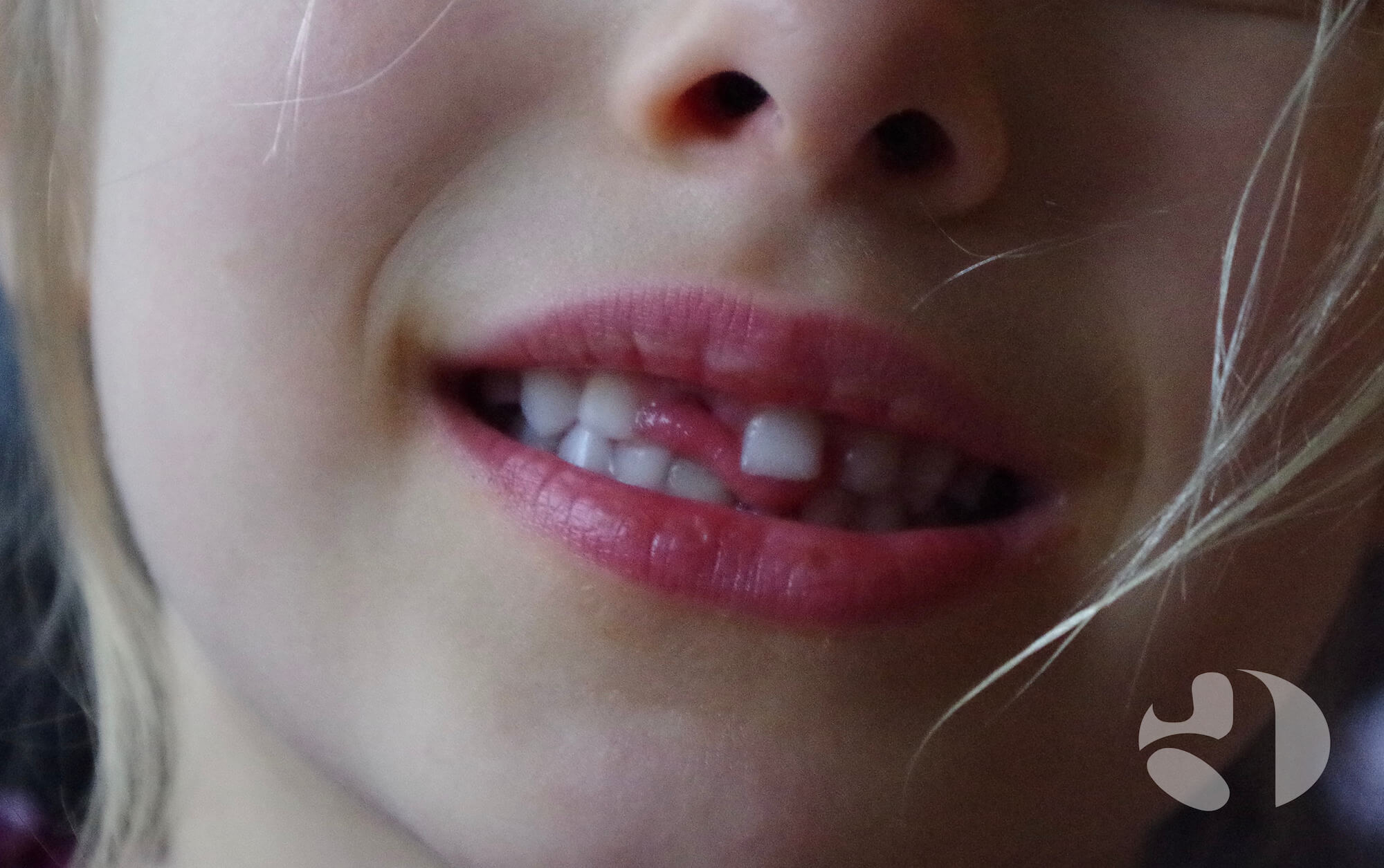 Lispeln bei Kindern (Sigmatismus) - TOTALVOKAL Düsseldorf